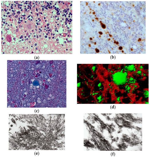 Kuru, the First Human Prion Disease
