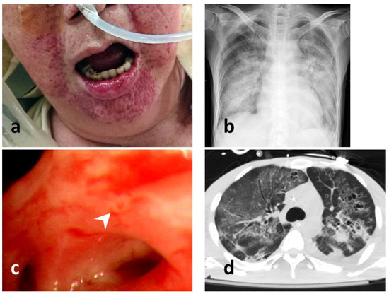 Outcomes of Herpes Simplex Virus Pneumonitis in Critically Ill Patients