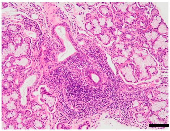 Virus Infections Play Crucial Roles in the Pathogenesis of Sjögren’s ...
