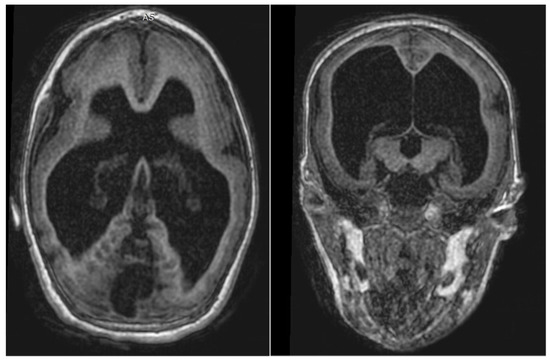 Cortical Auditory Evoked Potentials in Children with Prenatal Exposure ...