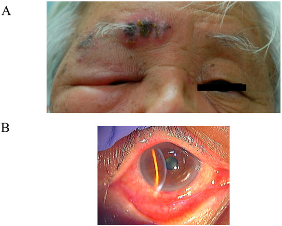 Viral Conjunctivitis