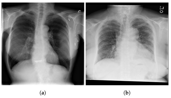 Explainable COVID-19 Detection Based on Chest X-rays Using an End-to-End RegNet Architecture