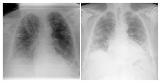 Explainable COVID-19 Detection Based on Chest X-rays Using an End-to-End RegNet Architecture