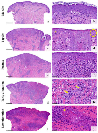 Lives of Skin Lesions in Monkeypox: Histomorphological ...