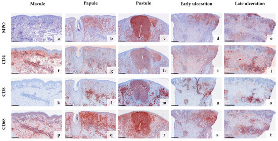 Lives of Skin Lesions in Monkeypox: Histomorphological ...