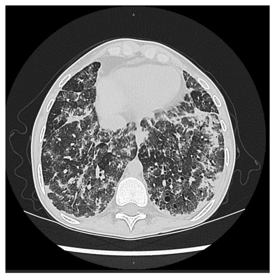 Viruses | Free Full-Text | Herpes Virus Infection in Lung ...