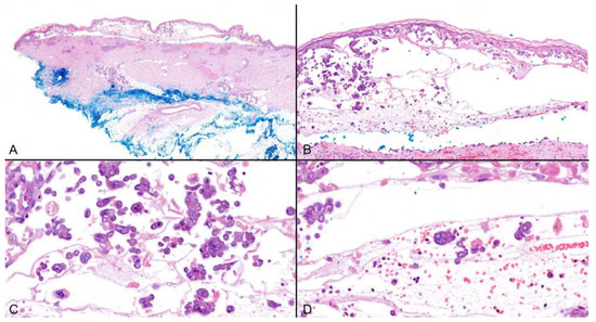 A Review of Atypical Cutaneous Histological Manifestations of Herpes Zoster