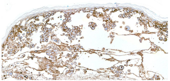 A Review of Atypical Cutaneous Histological Manifestations of Herpes Zoster