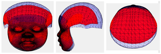 3D Head Shape Feature Analysis of Zika-Infected Children