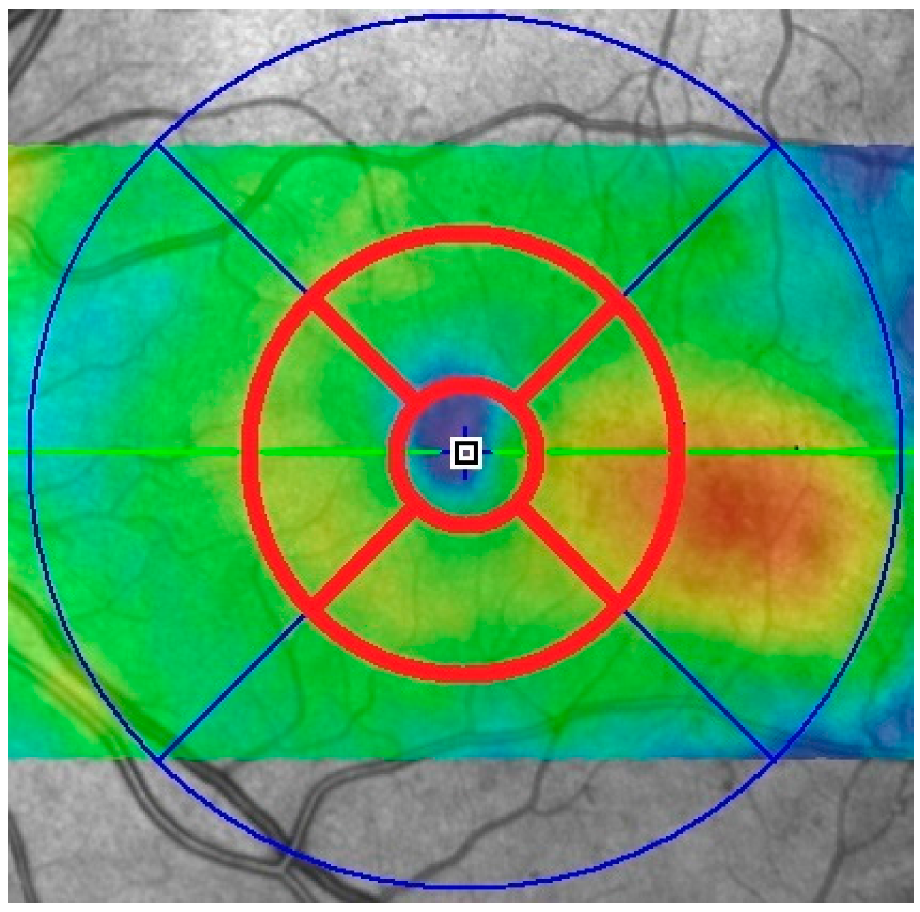 Comparing Macular Thickness Measurements in Patients with Diabetic ...