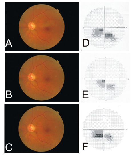 The Horizontal Raphe of the Human Retina and its Watershed Zones