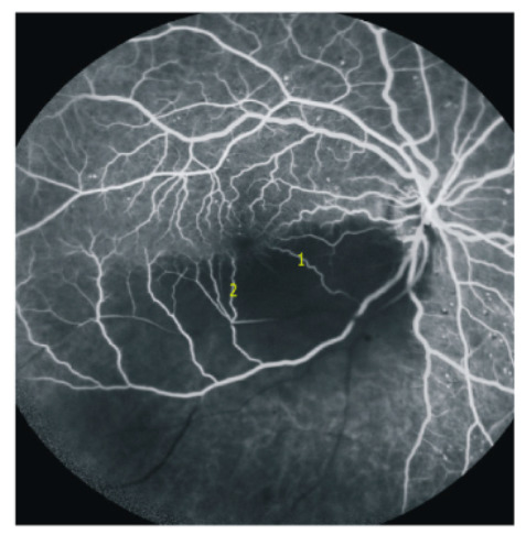 The Horizontal Raphe of the Human Retina and its Watershed Zones