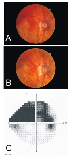 The Horizontal Raphe of the Human Retina and its Watershed Zones