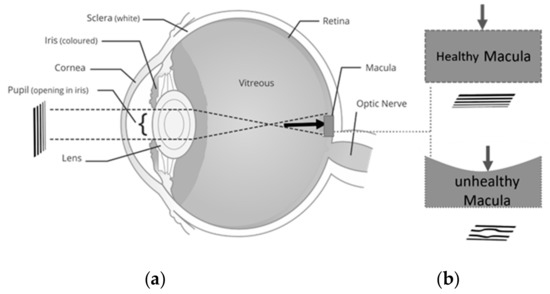 Vision | Free Full-Text | A Novel Method for Detection and Progress ...