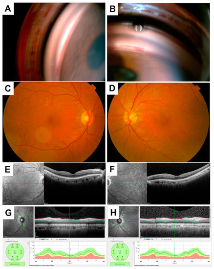 Time Course in Ocular Blood Flow and Pulse Waveform in a Case of Ocular ...