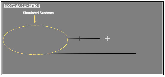 Vision | Free Full-Text | Visual Field Loss: Integrating Overlayed ...