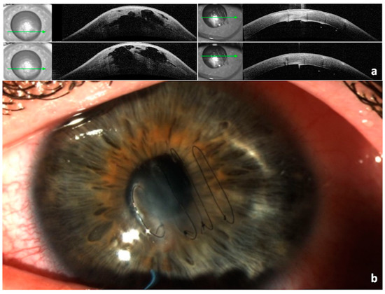 Full-Thickness Compressive Corneal Sutures with Removal of Anterior ...