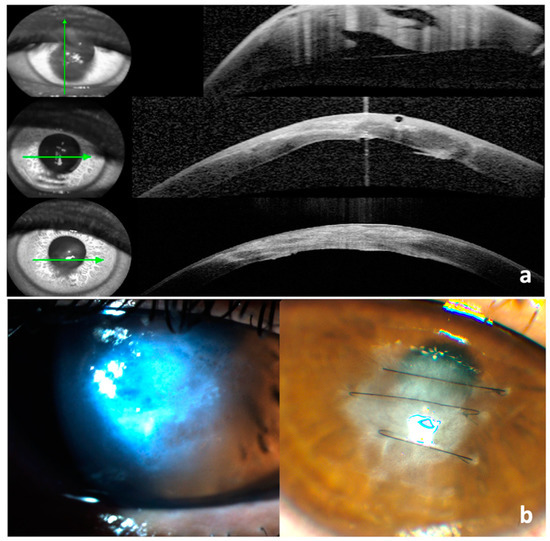 Full-Thickness Compressive Corneal Sutures with Removal of Anterior ...