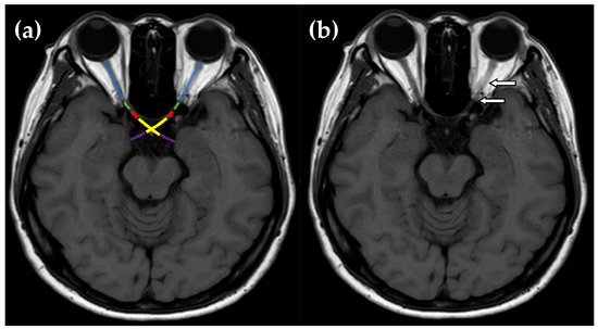 A 10-Year Single-Center Study of the Clinical Characteristics of Optic ...