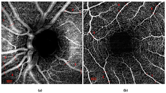 Repeatability and Comparability of Retinal Blood Vessel Caliber ...
