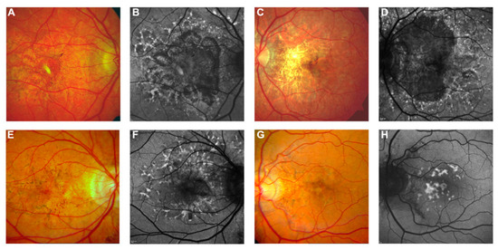 Angioid Streaks Remain a Challenge in Diagnosis, Management, and Treatment