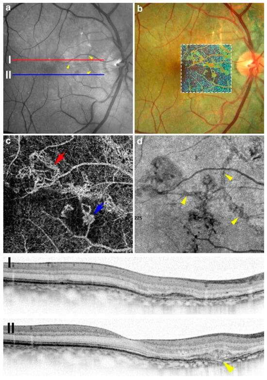 Angioid Streaks Remain a Challenge in Diagnosis, Management, and Treatment