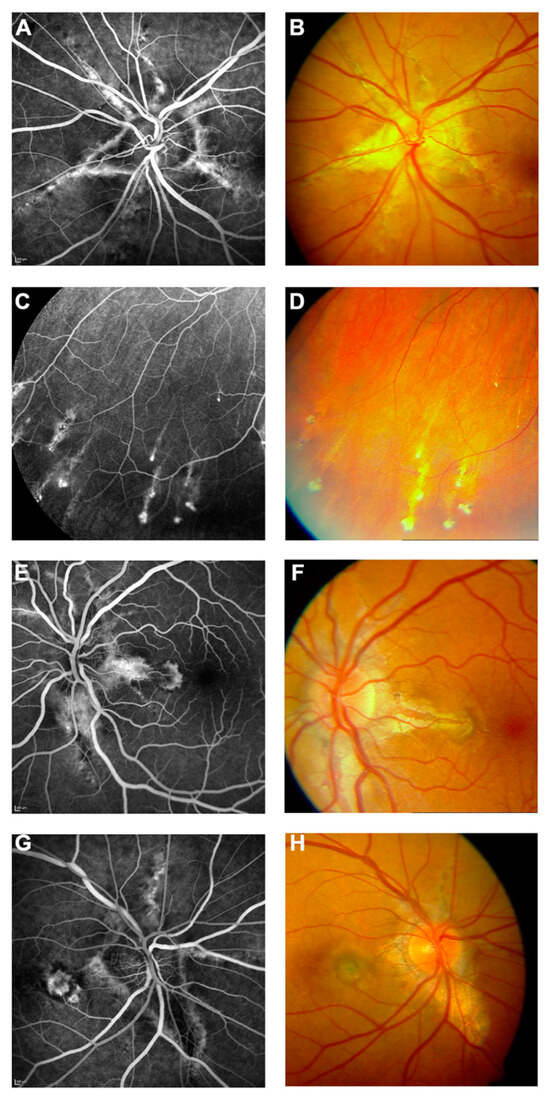 Angioid Streaks Remain a Challenge in Diagnosis, Management, and Treatment