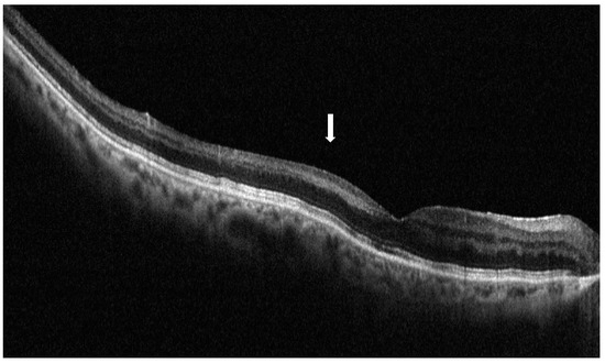 Paracentral Acute Middle Maculopathy (PAMM) in Ocular Vascular Diseases ...